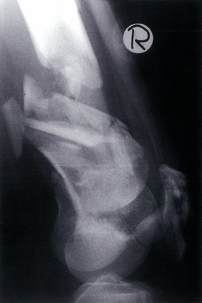Classification Of Femoral Fractures SpringerLink, 45% OFF