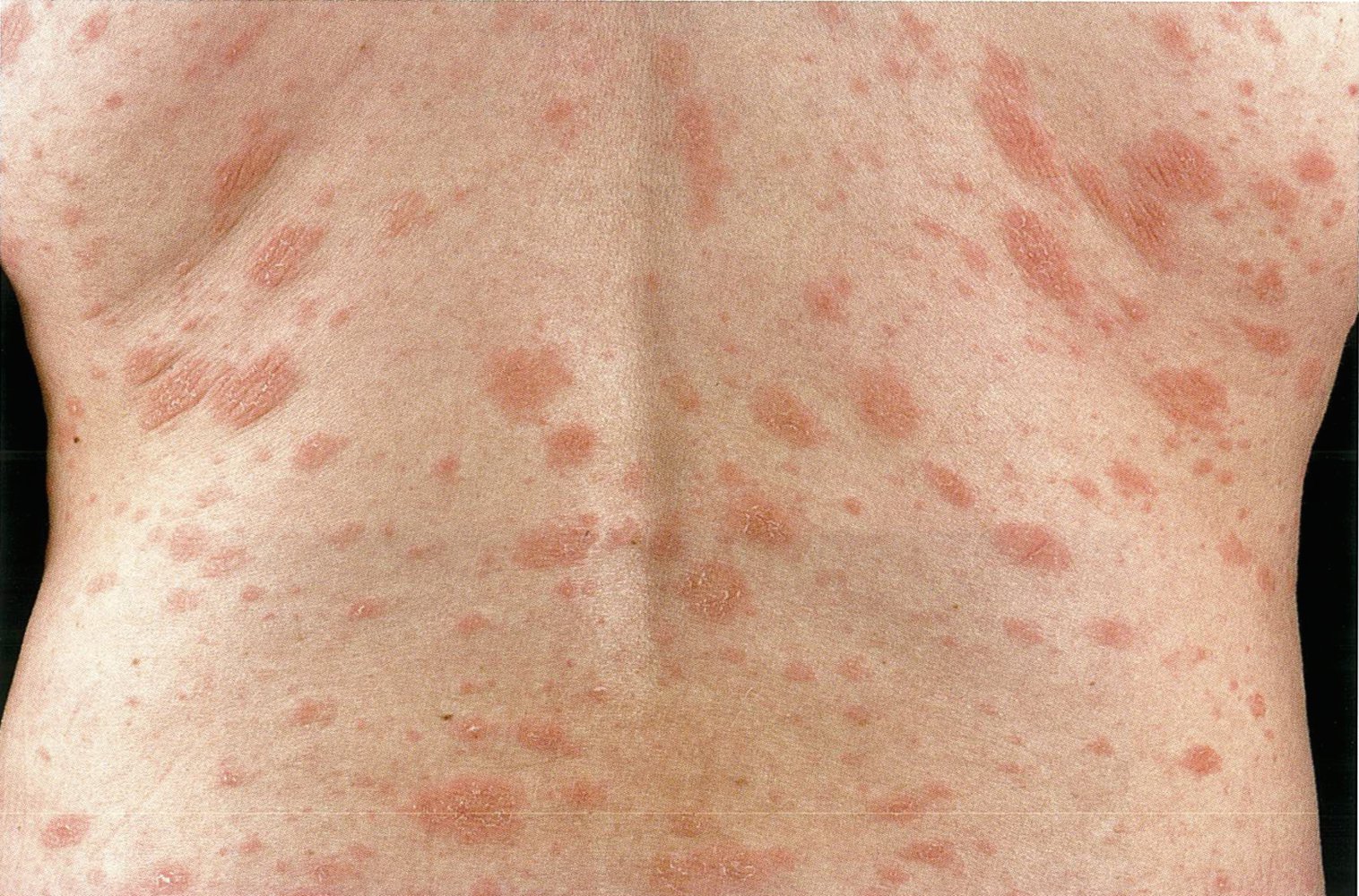 What Rash Looks Like Pityriasis Rosea Infoupdate