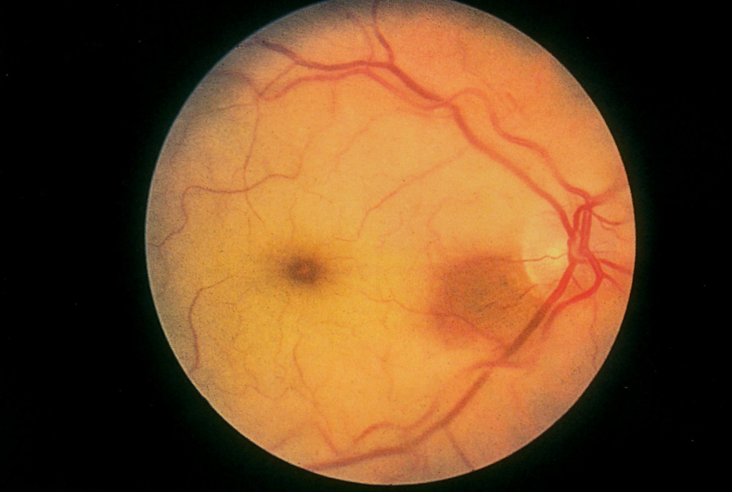 Central Retinal Artery Occlusion Geeky Medics