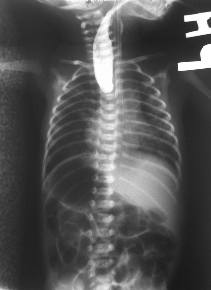 Tracheoesophageal Fistula X Ray Findings