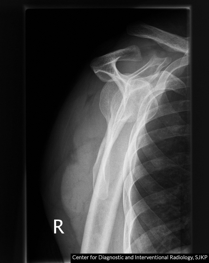 Clavicle Detached From Scapula