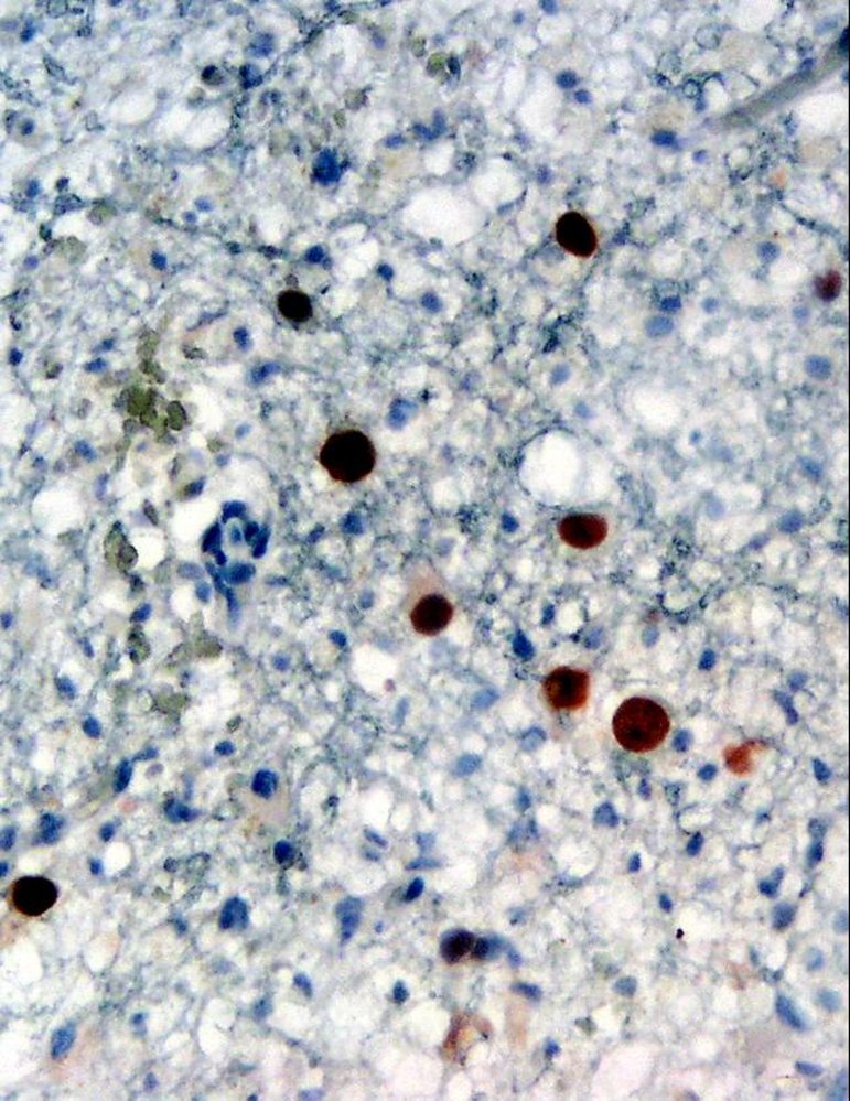 Progressive Multifocal Leukoencephalopathy Histology