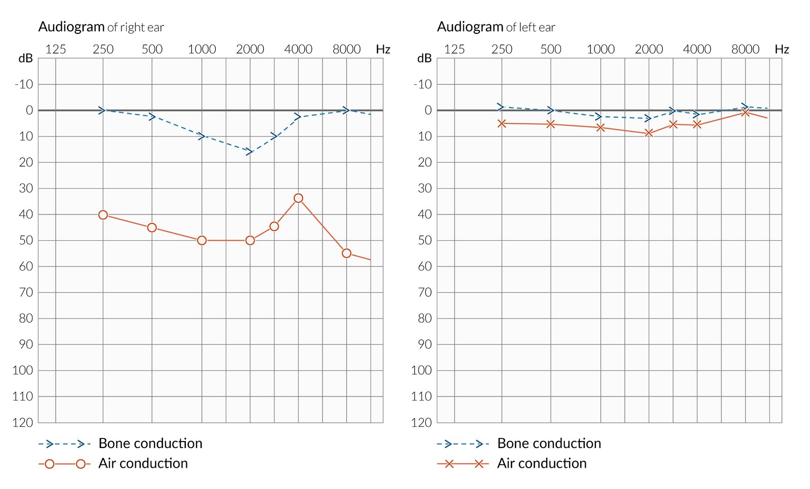 Air Conduction Bone Conduction Candidacy Guide For Bone 57 OFF