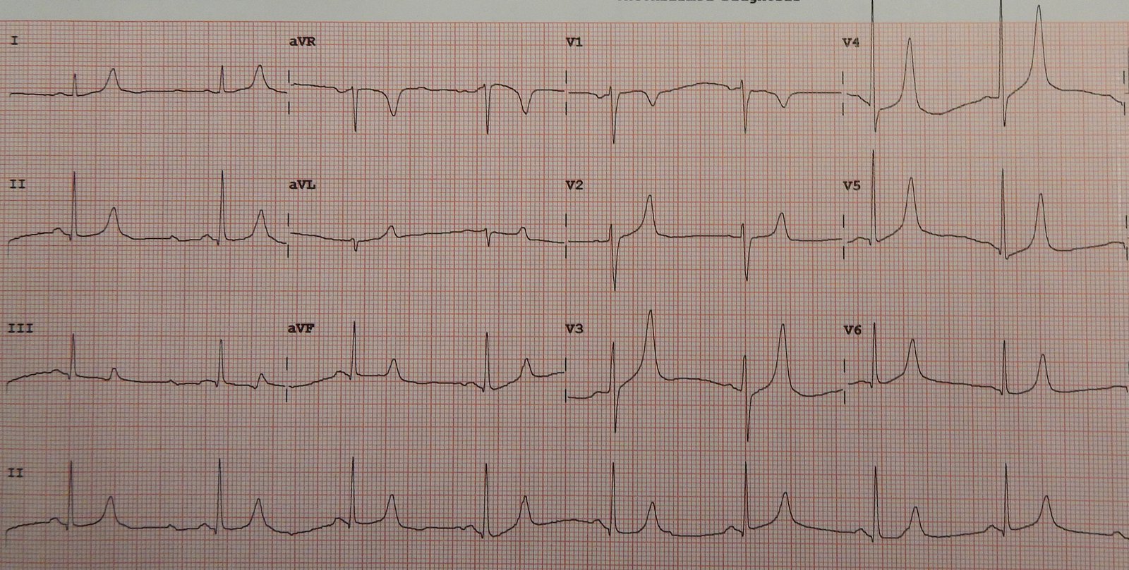 Hipercalemia Ecg