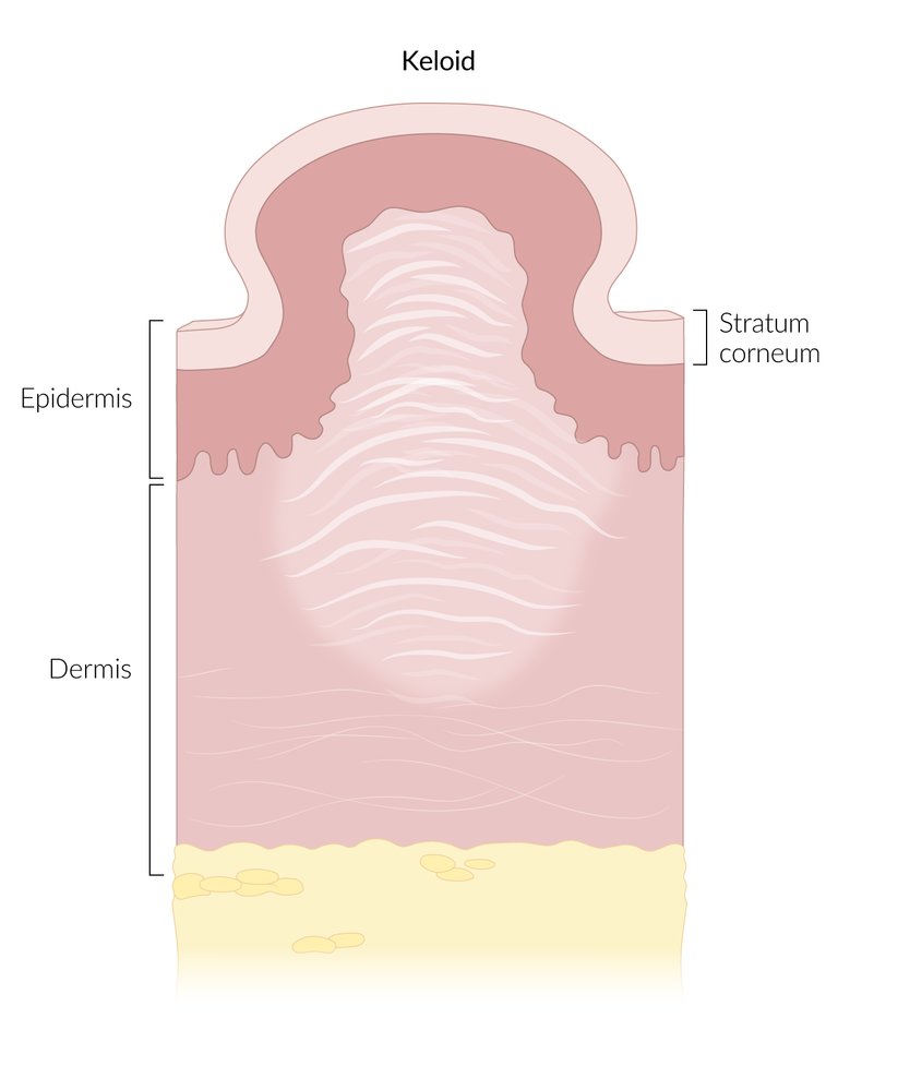 Keloid Scar Diagram Skin Scars | Quest Graphic Explaining How Scars