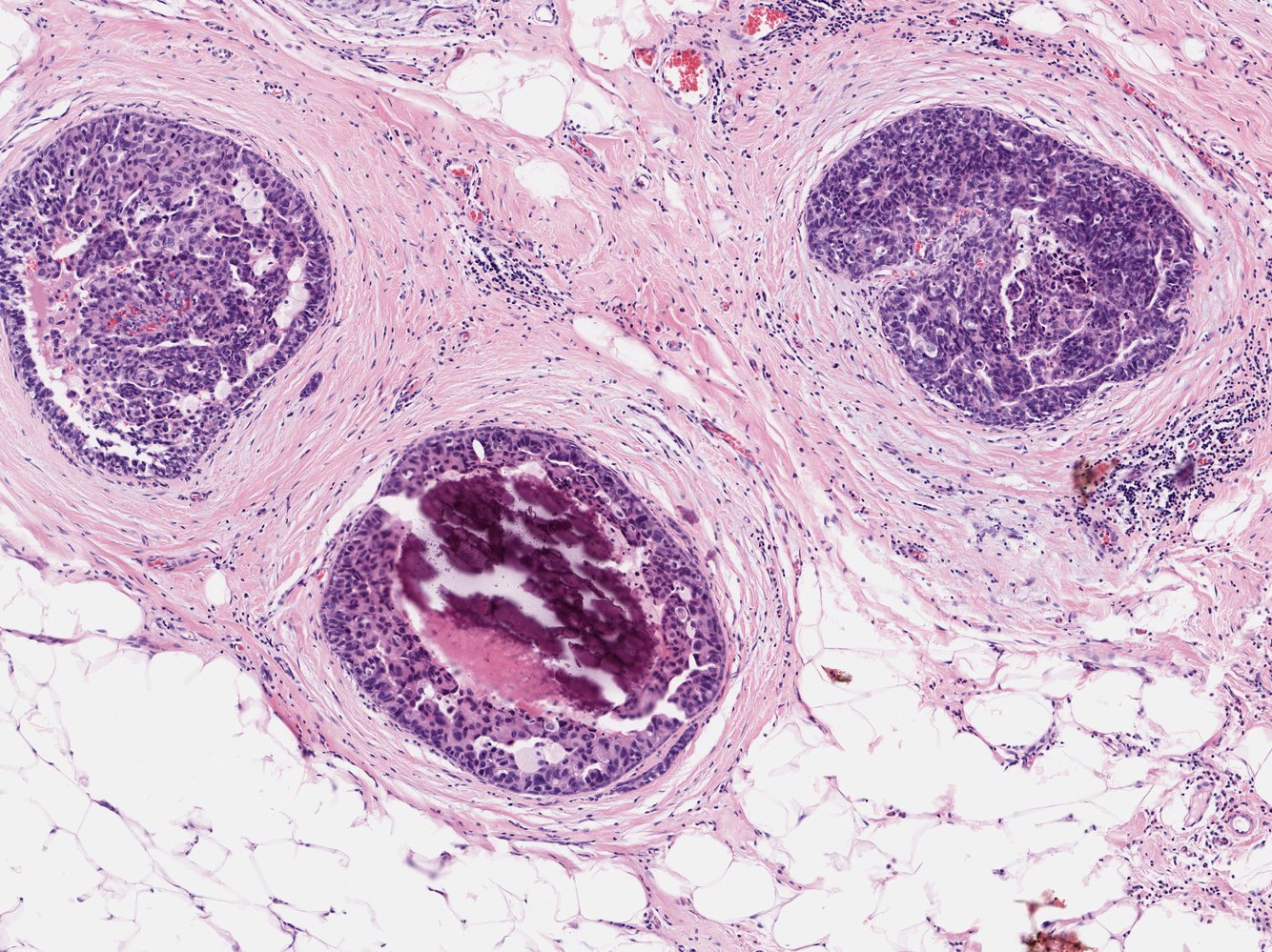 Invasive Ductal Carcinoma Histology