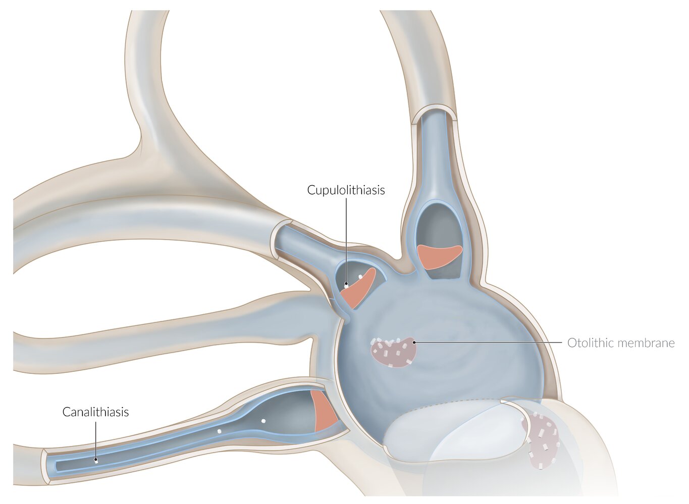 Benign Positional Vertigo Inner Ear Vestibular Neuritis | Symptoms,