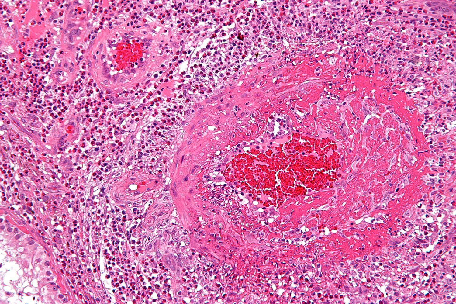 Leukocytoclastic Vasculitis Histology