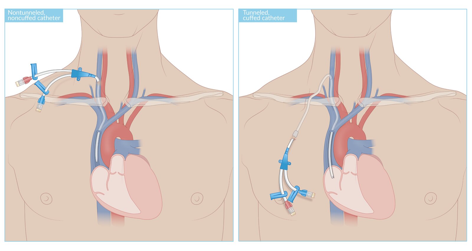 Tunneled Central Line Tunneled Central Venous Catheter 53 OFF
