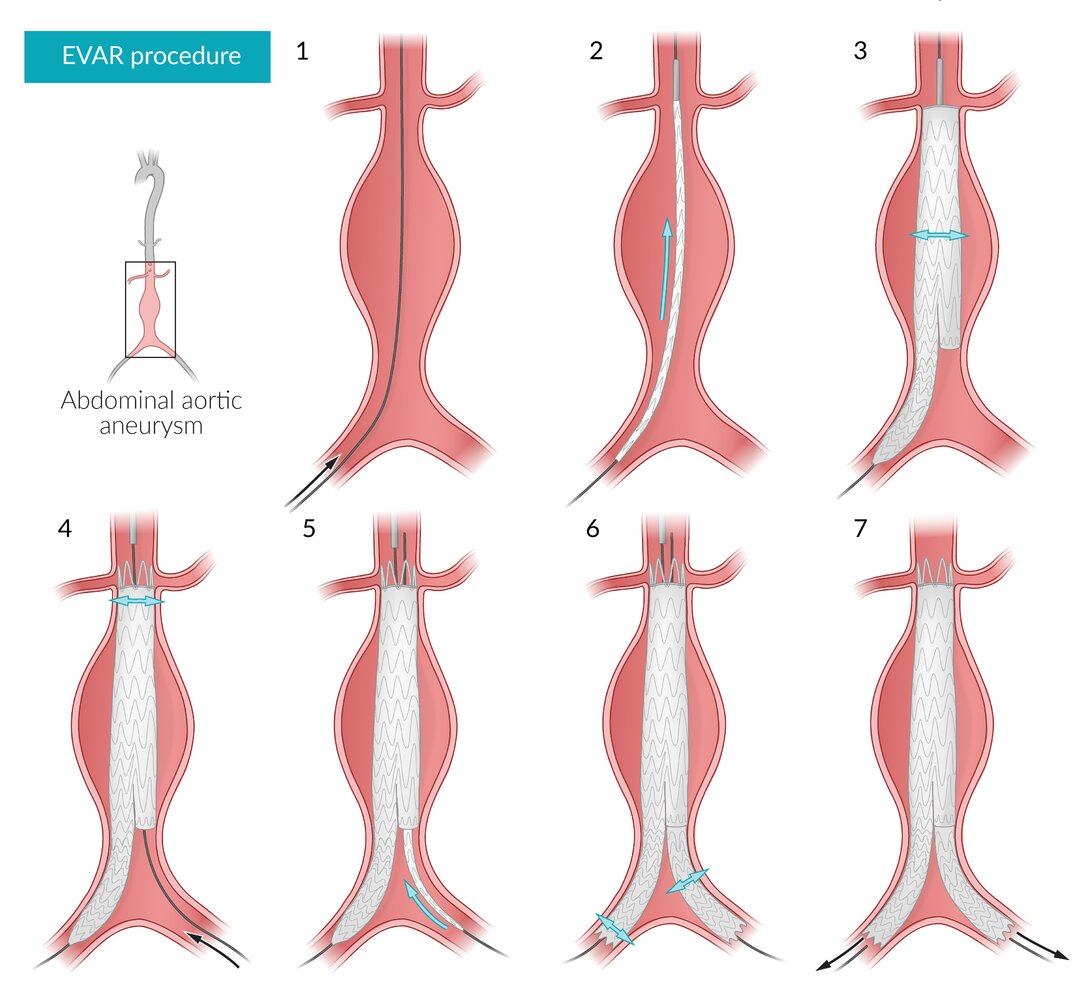 Endovascular Aneurysm Repair EVAR 
