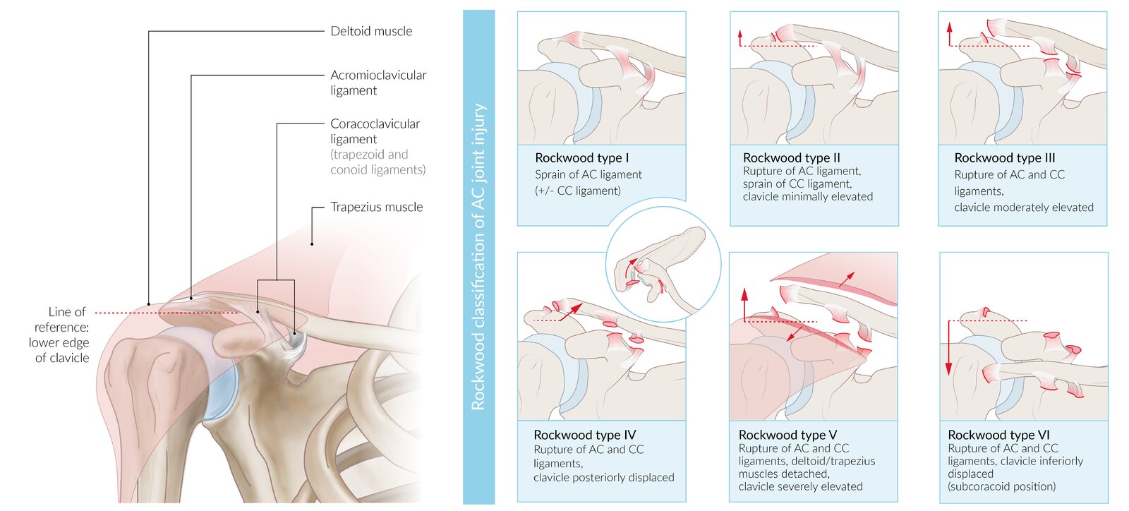 Rockwood Classification Of Acromioclavicular Joint Acromioclavicular