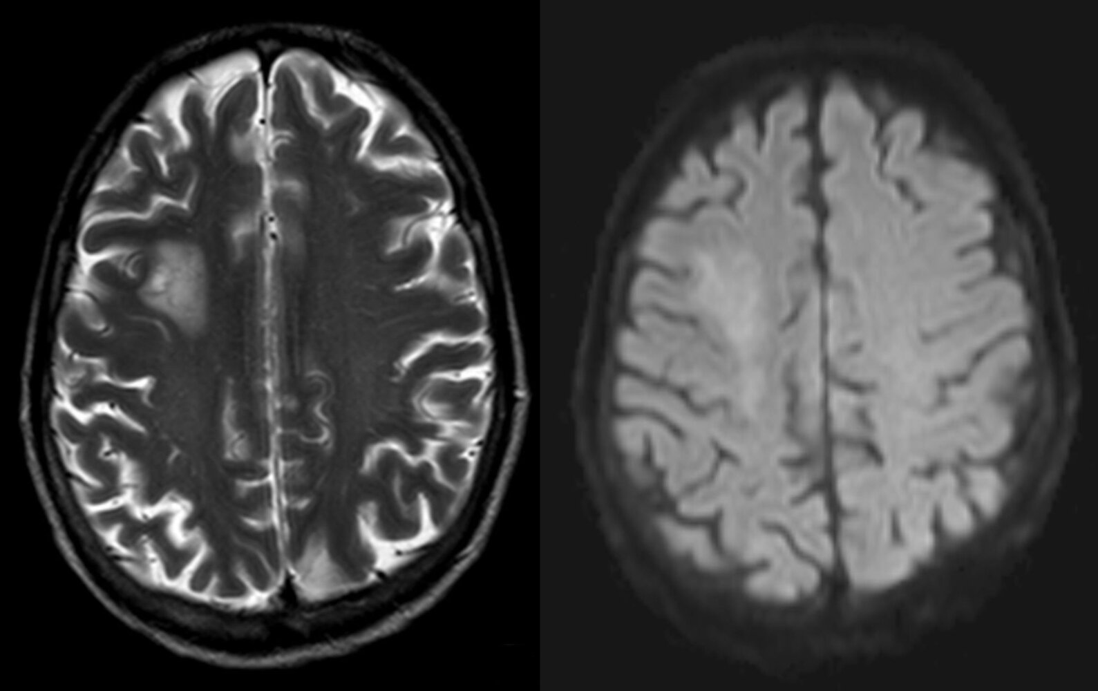 Progressive Multifocal Leukoencephalopathy Mri
