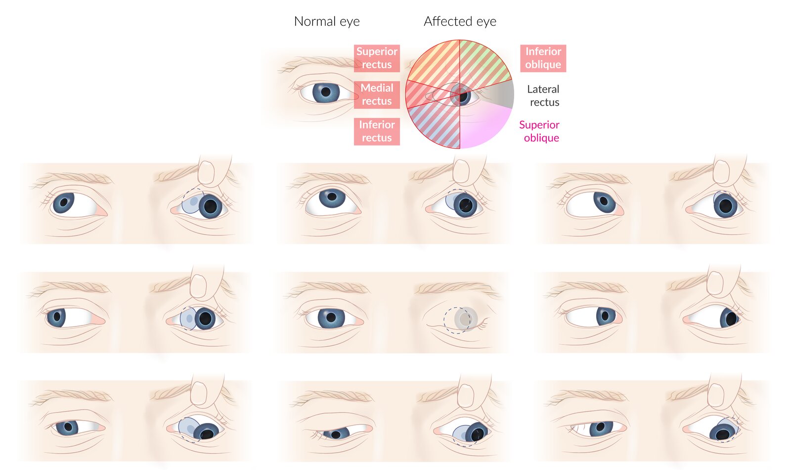 Causes For Strabismus Cranial Nerve Palsy PinpointEyes 41 OFF
