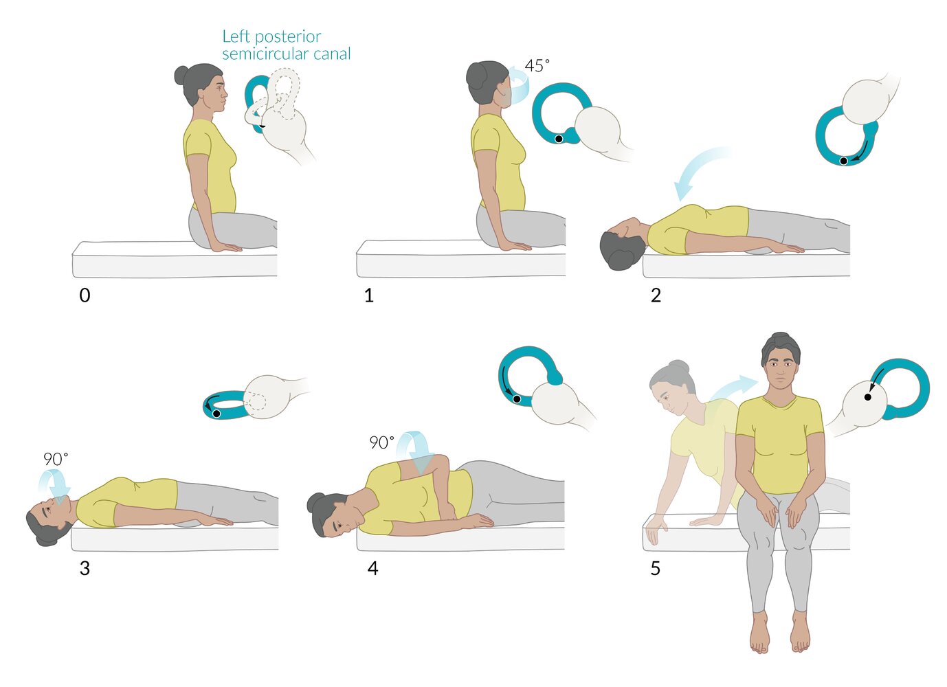 Epley Maneuver Assessment Benign Paroxysmal Positional Vertigo | New