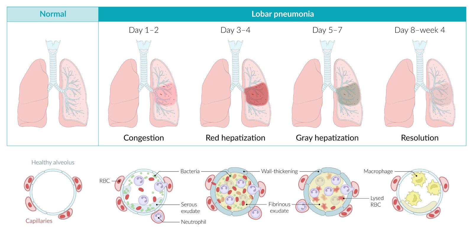 Atypical Pneumonia