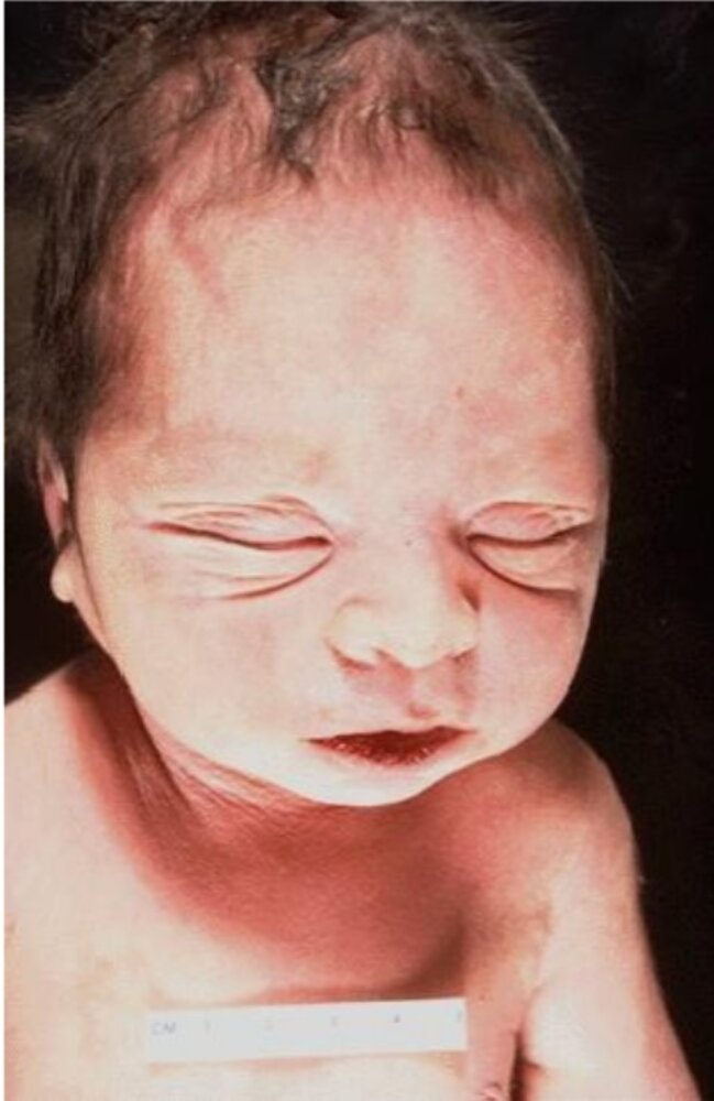 Oligohydramnios Potters Syndrome Magical Nursing Classes Potter