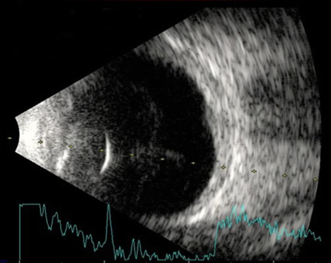 Rhegmatogenous Retinal Detachment B Scan