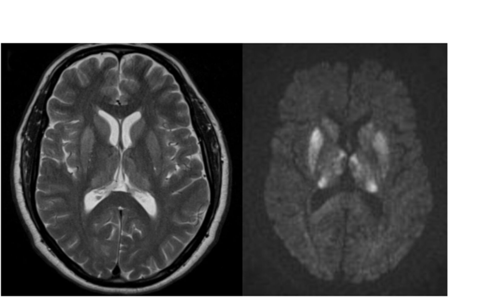 Creutzfeldt Jakob Disease Mri