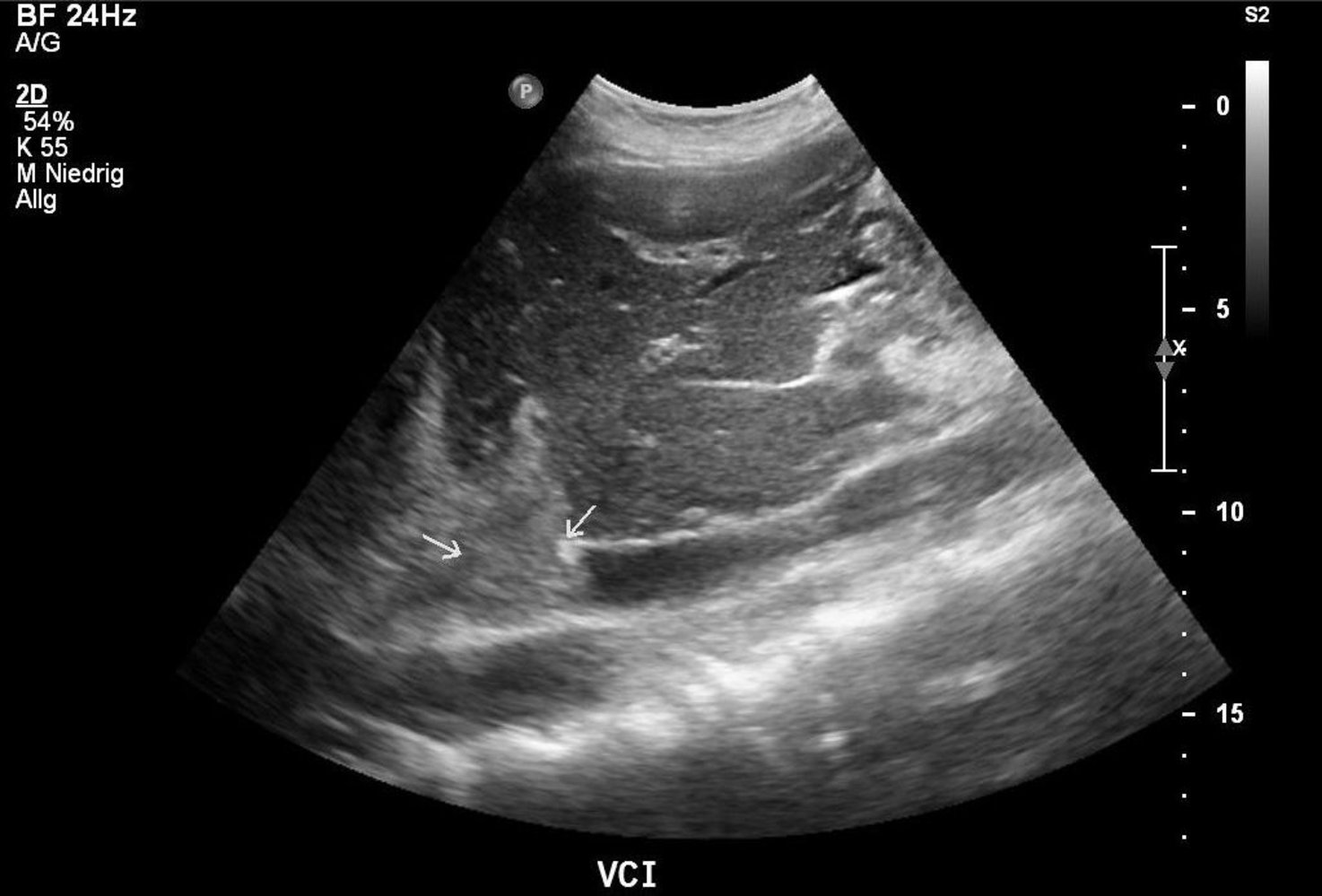 Plethora In Polycythemia Vera