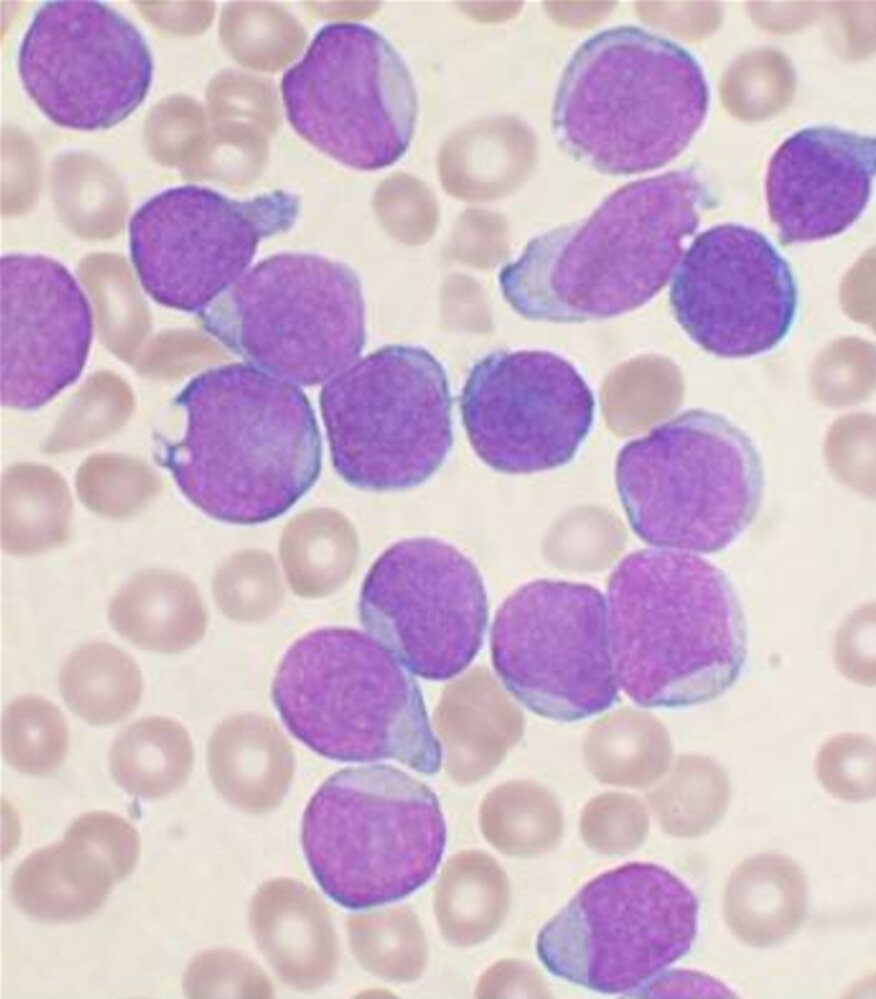 Acute Myelomonocytic Leukemia