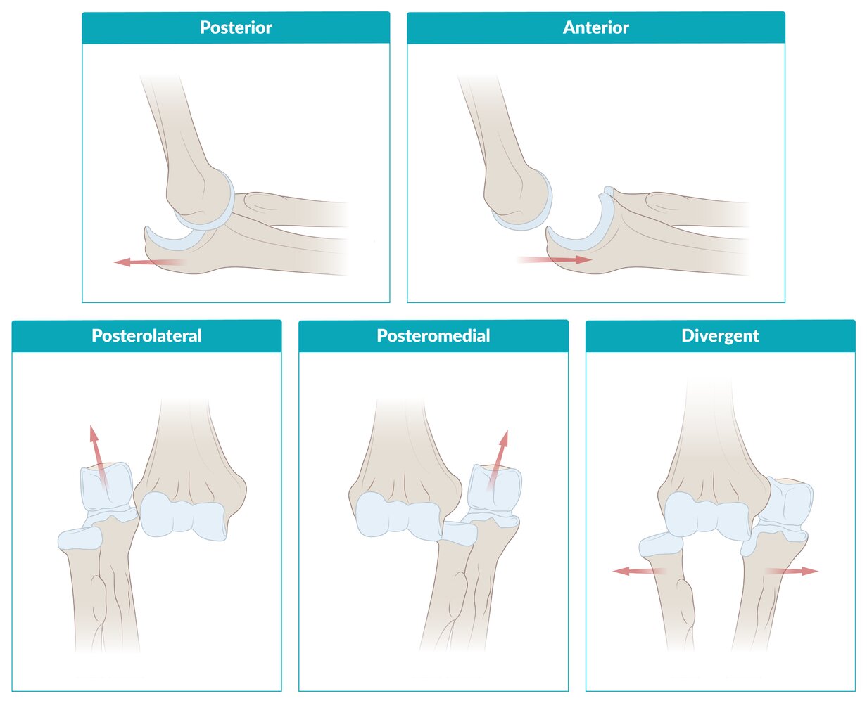 Elbow Dislocation Classification