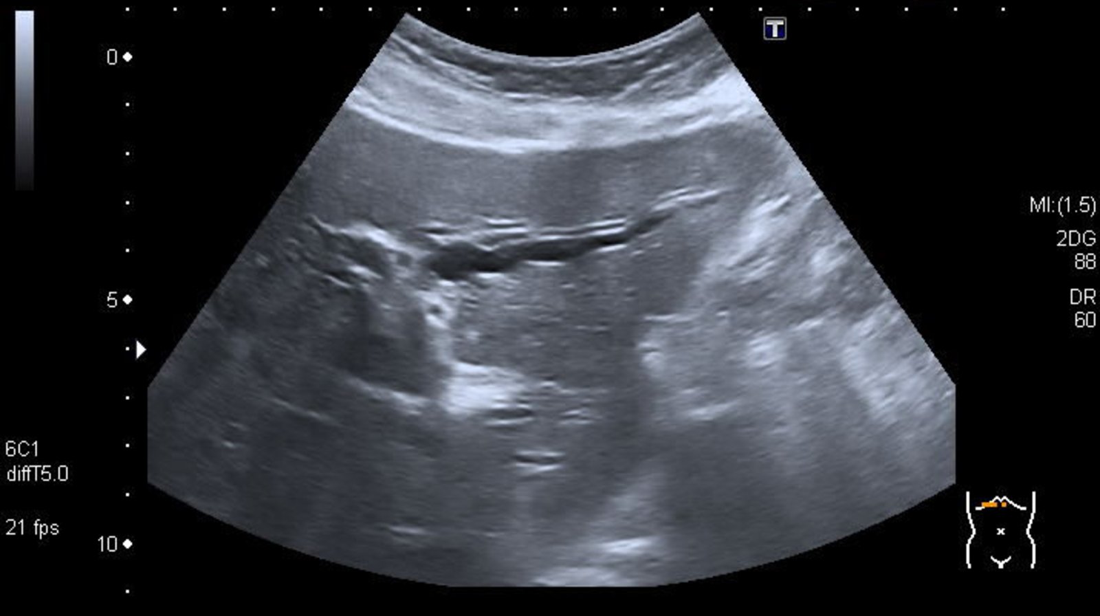 Cholangitis Ultrasound Intraoperative Sonography Of The Biliary System