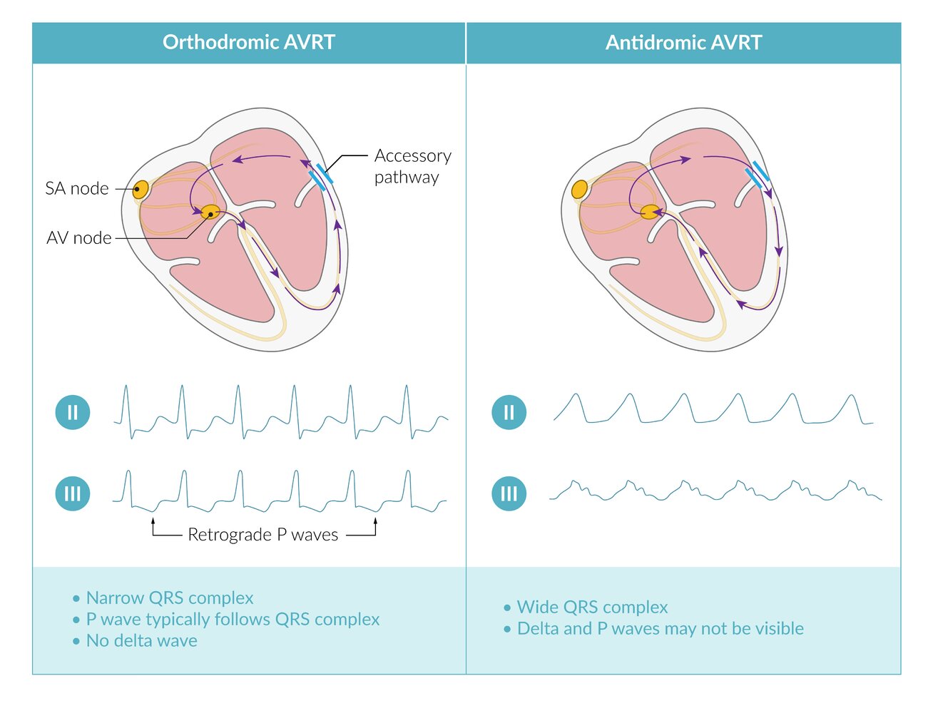 Common Types Of Supraventricular Tachycardia Diagnosis And 58 OFF