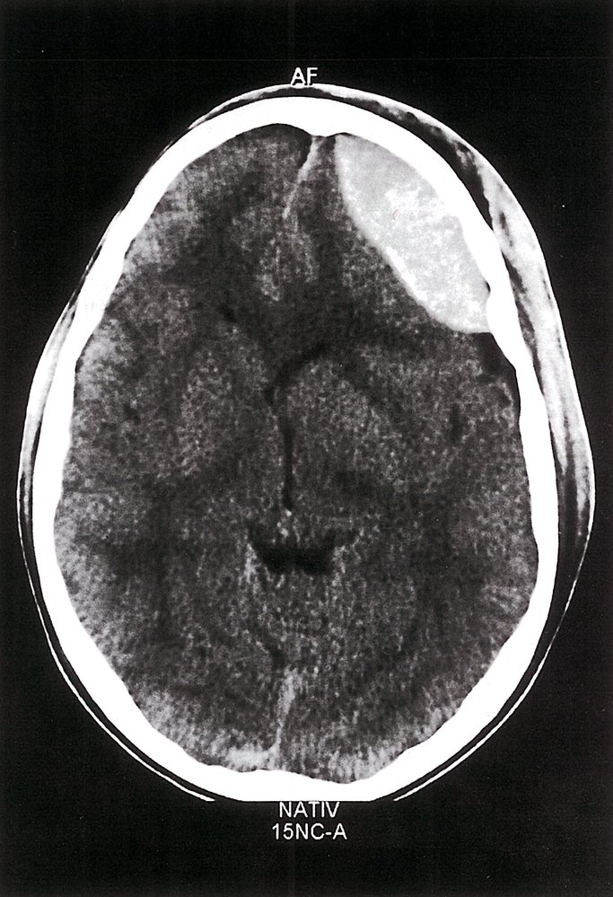 Epidural Hematoma Suture Lines