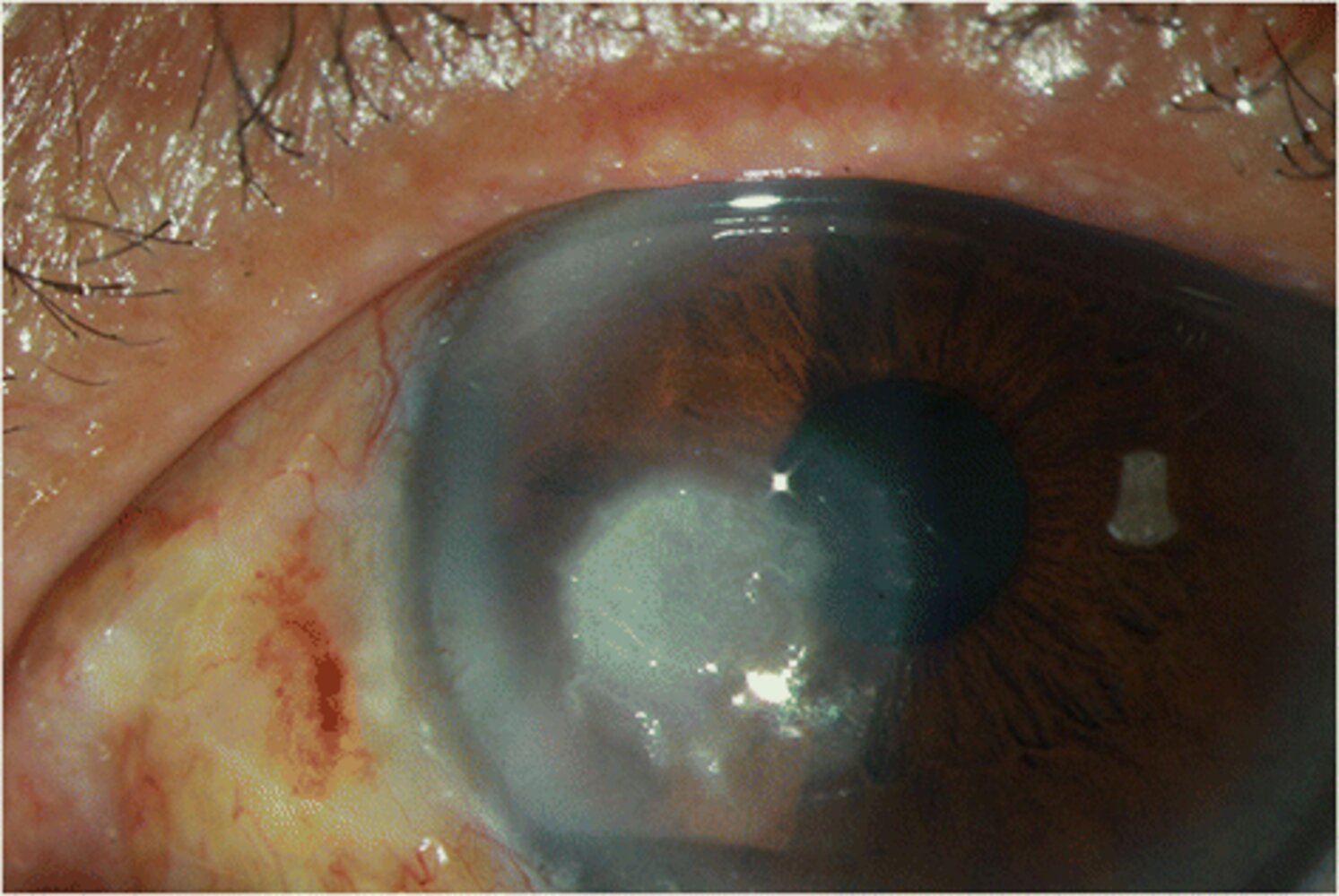Corneal Ulcer