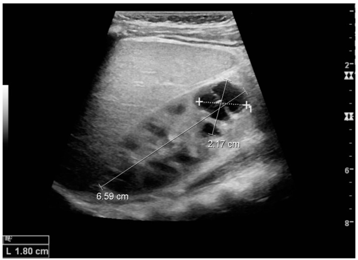 Simple Cyst Kidney Ultrasound