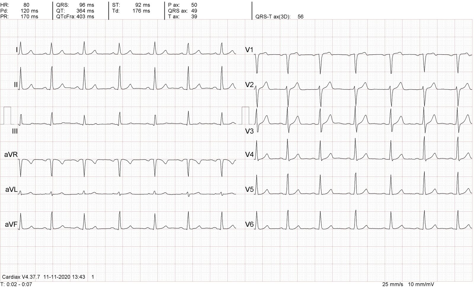 Hypomagnesemia Ecg