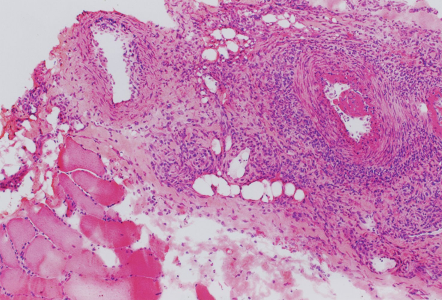 Urticarial Vasculitis Histology