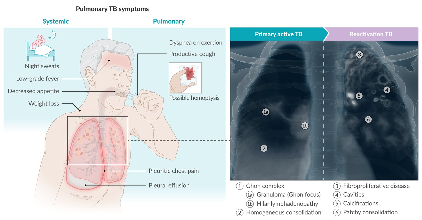 Pulmonary Tuberculosis Symptoms