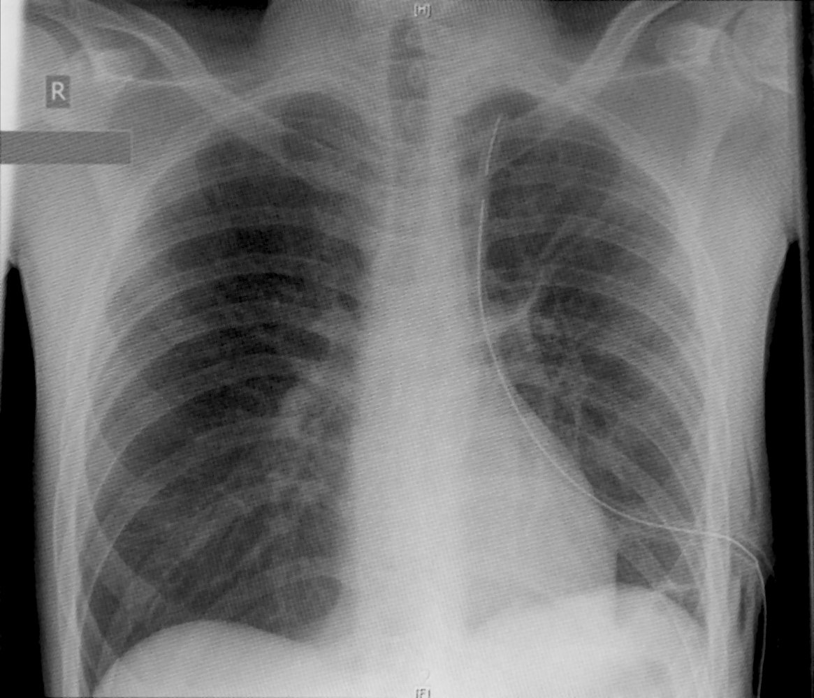 Pneumothorax Knowledge AMBOSS 58 OFF