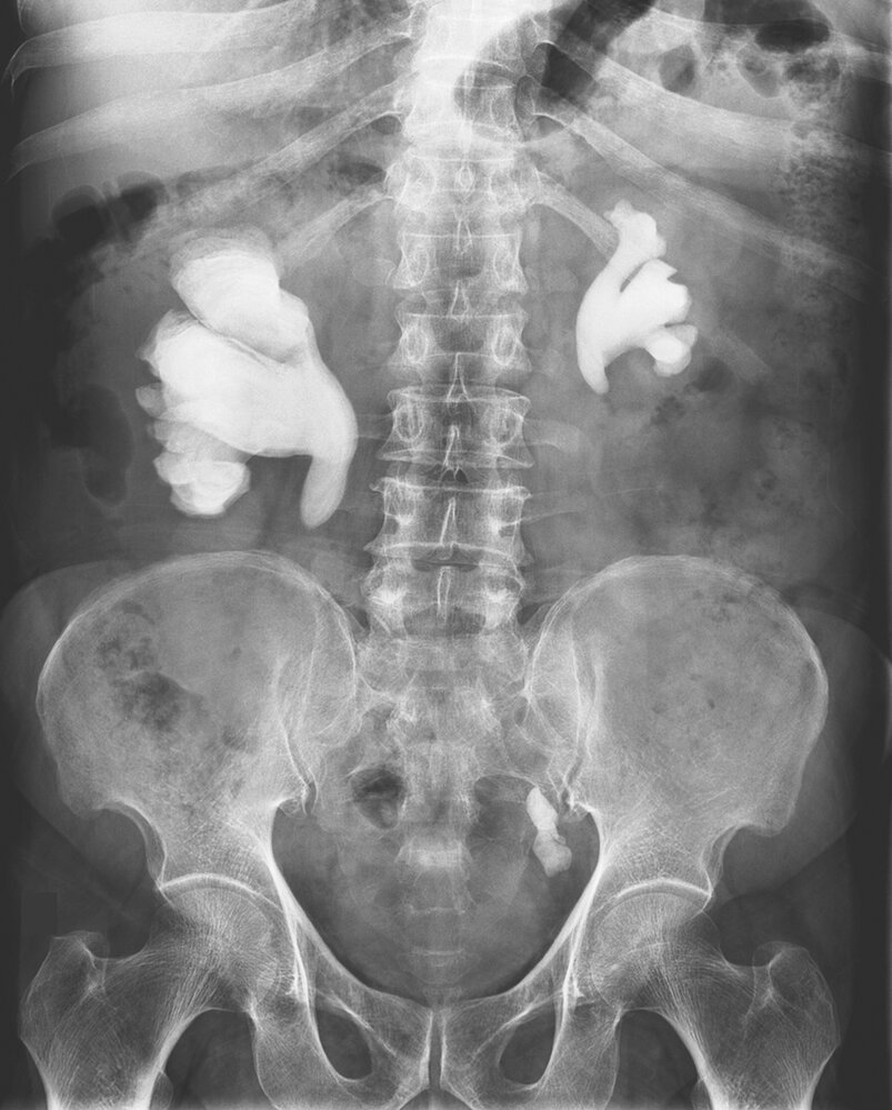 Nephrolithiasis Amboss