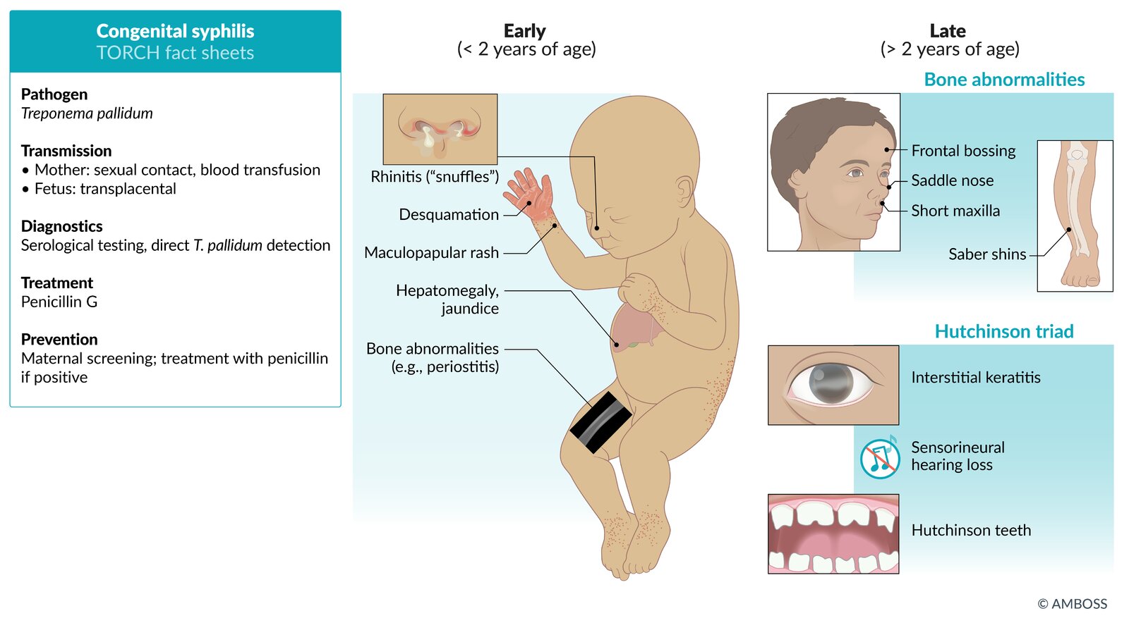 Toxoplasmosis Birth Defects