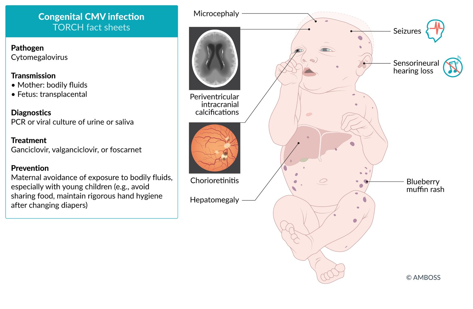 Neonatal Group B Strep Rash