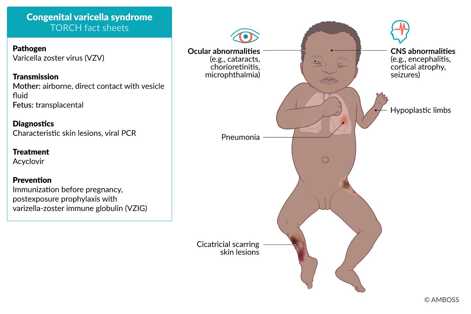 Toxoplasmosis Birth Defects