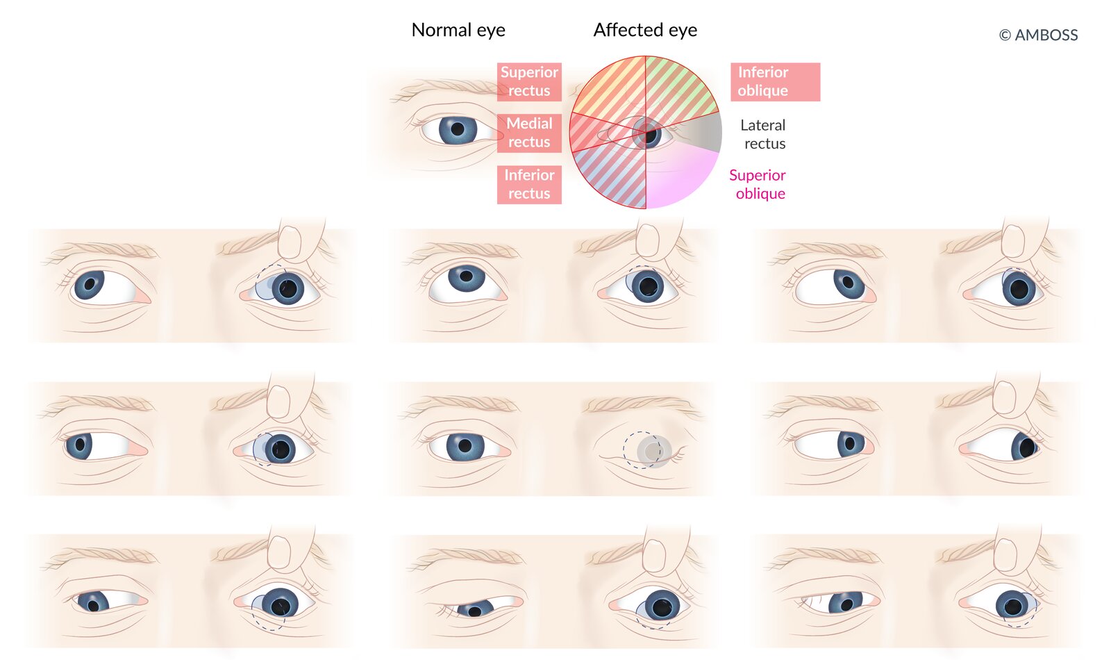 Trochlear Nerve Palsy Surgical Treatment Of Fourth Cranial Nerve