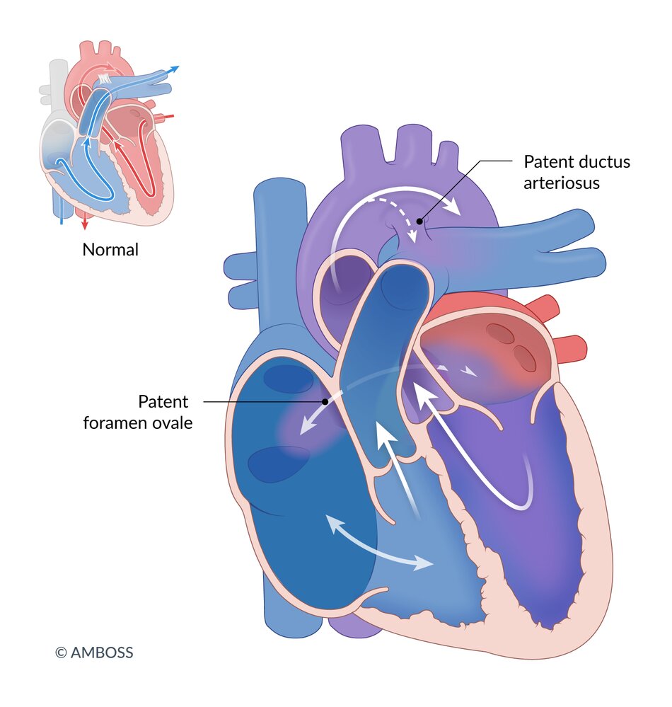 What Are The Cyanotic Congenital Heart Disease