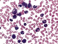 Leukoerythroblastic reaction