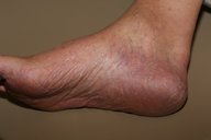 Tinea unguium ( onychomycosis )