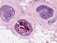 Benign and malignant tumors