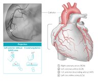 Percutaneous coronary intervention ( PCI )/ percutaneous transluminal ...
