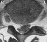 Nonspinal Causes Of Sciatica 1