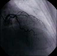 Percutaneous coronary intervention ( PCI )/ percutaneous transluminal ...