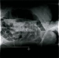 Perforation of hollow organs
