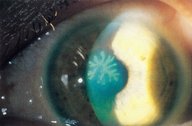 Herpes zoster keratitis [7] [8]