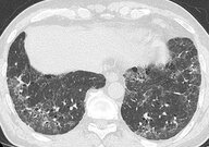 Scleroderma renal crisis