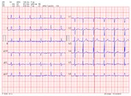 Premature ventricular beats